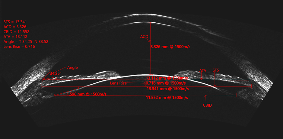 ArcScan Insight 100® Ophthalmic Ultrasound | ArcScan