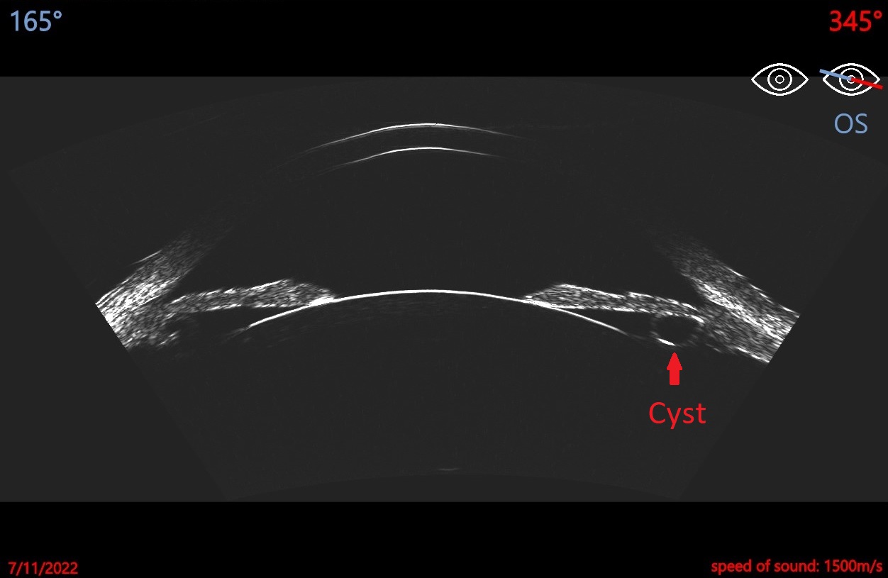 pIOL Sizing | ArcScan